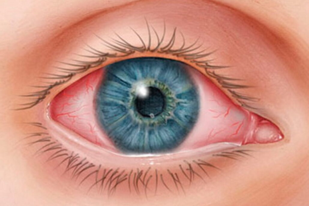 Conjunctivitis & Red Eye - Healthtips by TeleMe