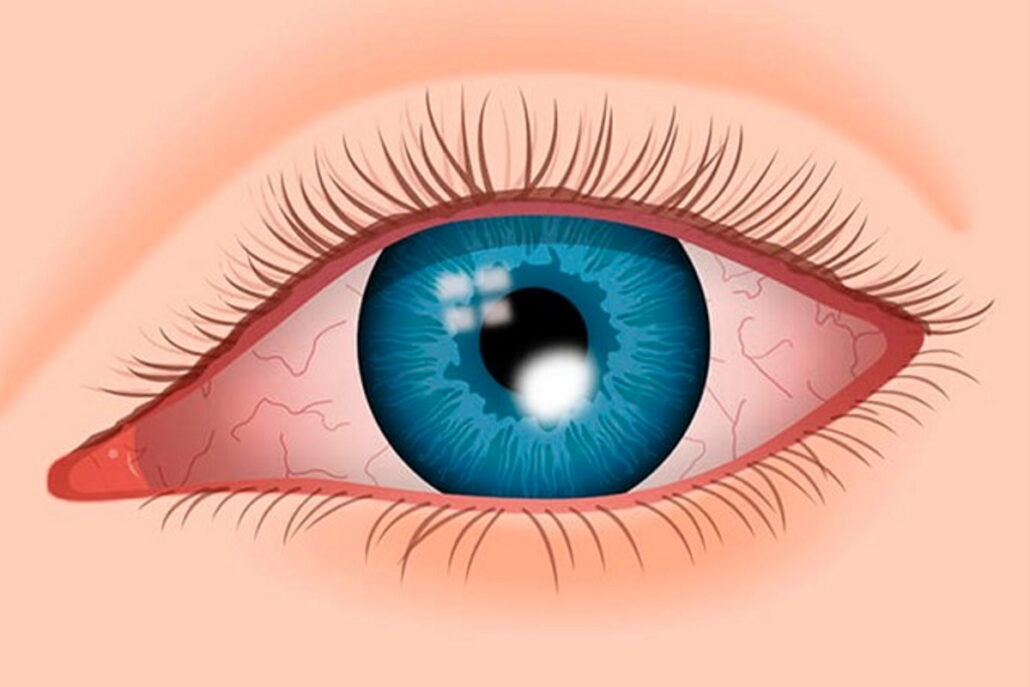 Corneal Ulcers - Healthtips by TeleMe
