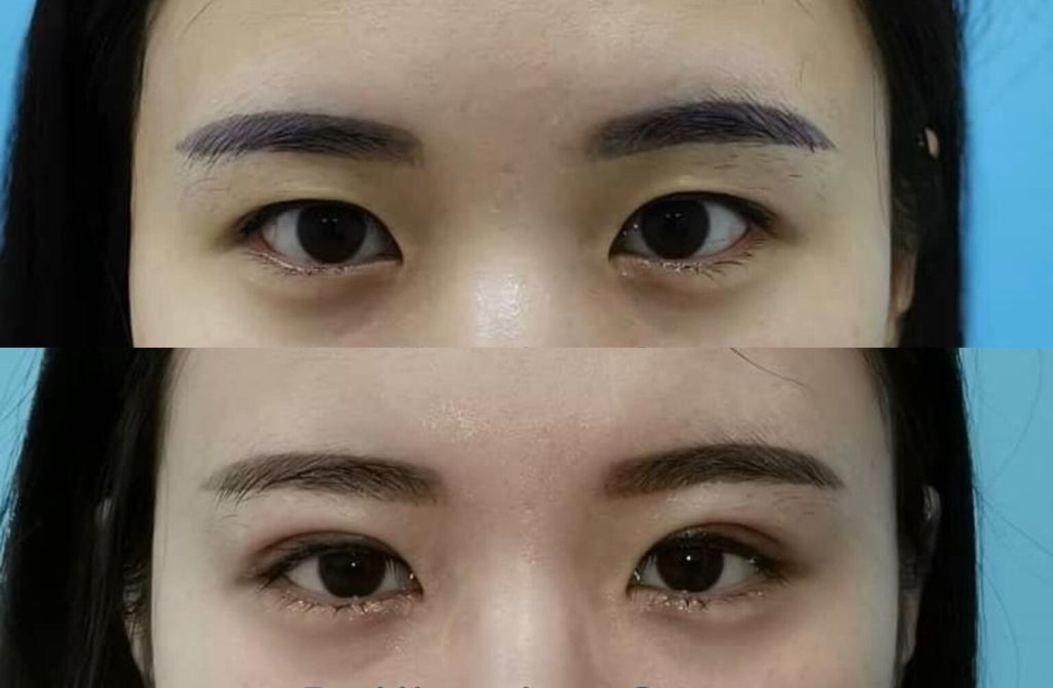 Asian Blepharoplasty (Double Eyelid Surgery) - Healthtips by TeleMe